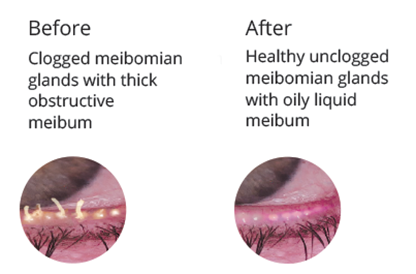 Dry Eye Treatments - Cacoullis Opticians